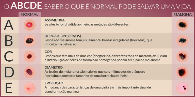 Remoção de Nevos: Proteja Sua Pele com Segurança - Dra. Natani Marreiros